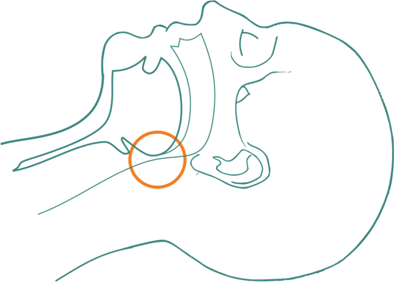 Sleep Apnea - TMJ & Sleep Therapy Centre South Africa